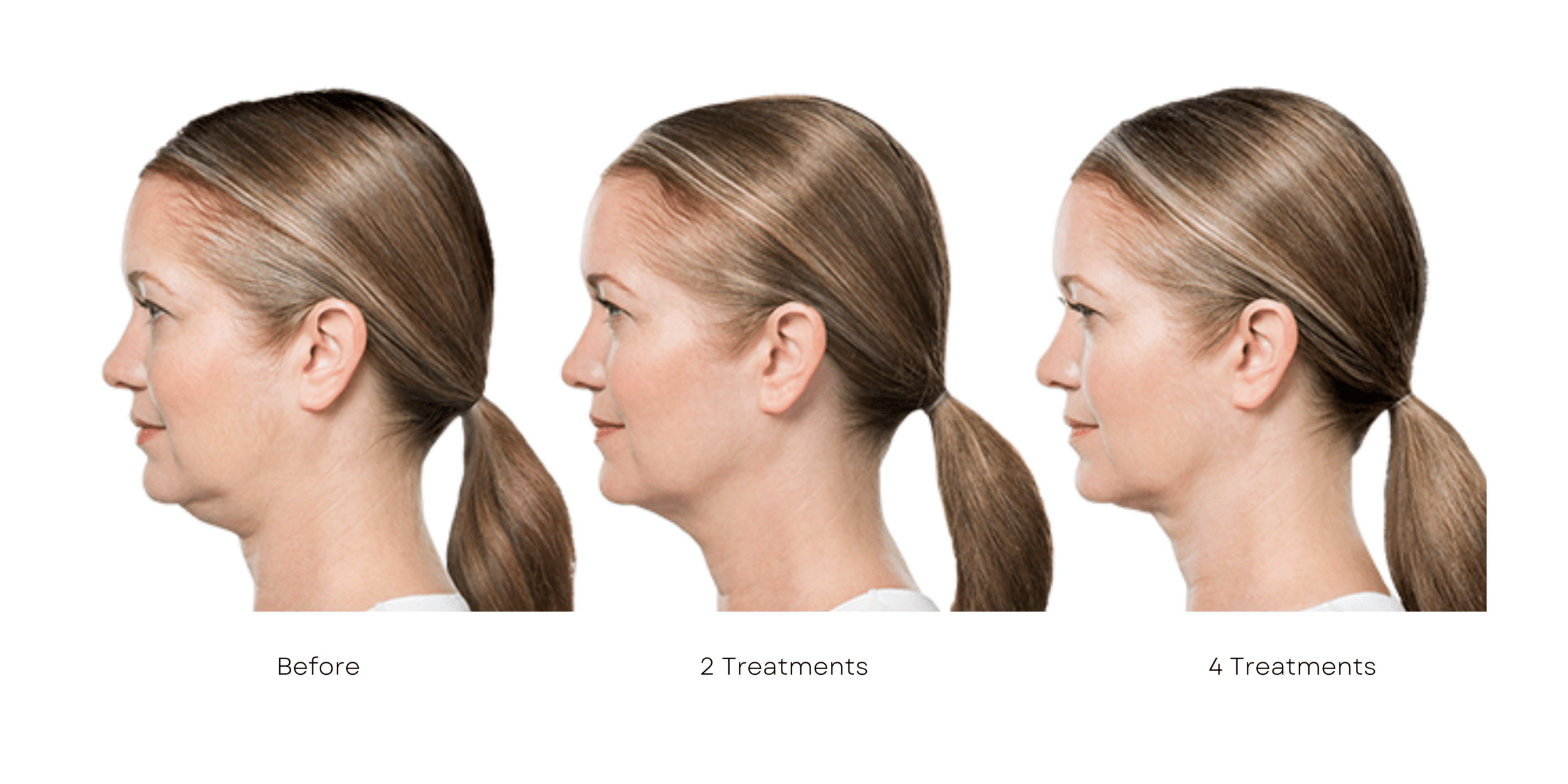 Kybella injections for double chin reduction in Cincinnati OH
