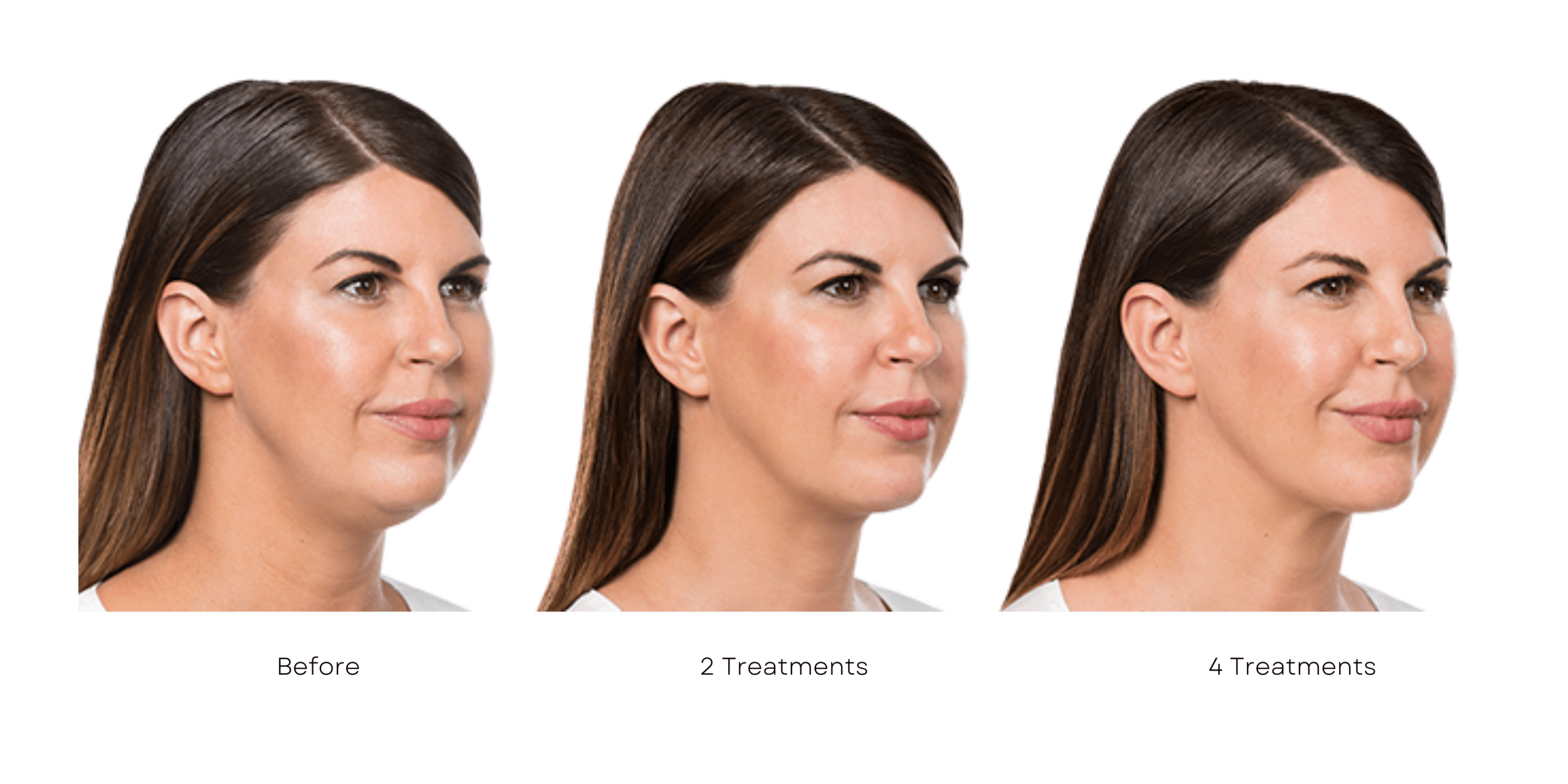 Kybella injections for double chin reduction in Cincinnati OH
