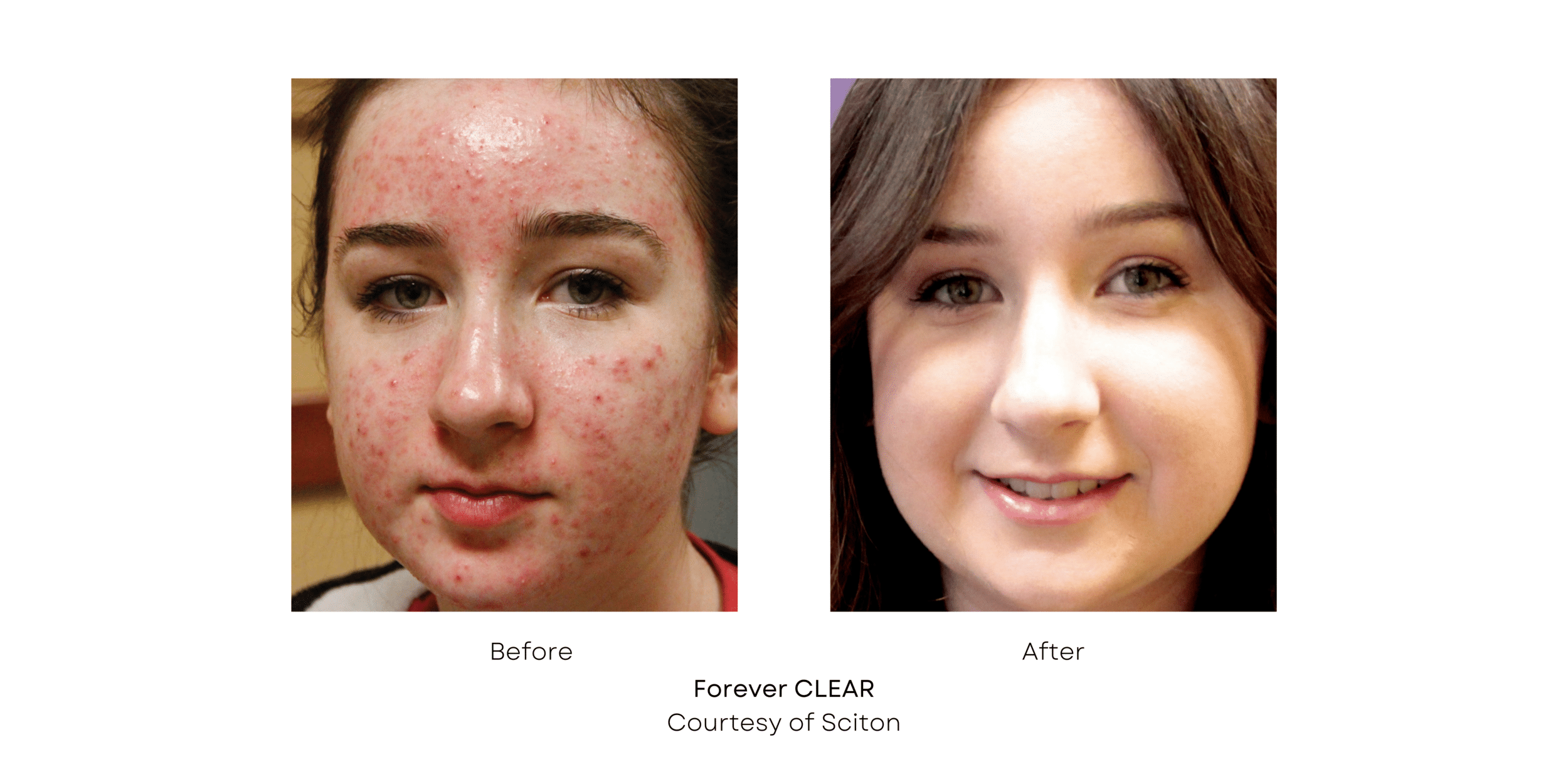 Nonsurgical BBL treatments in Cincinnati OH & Covington KY