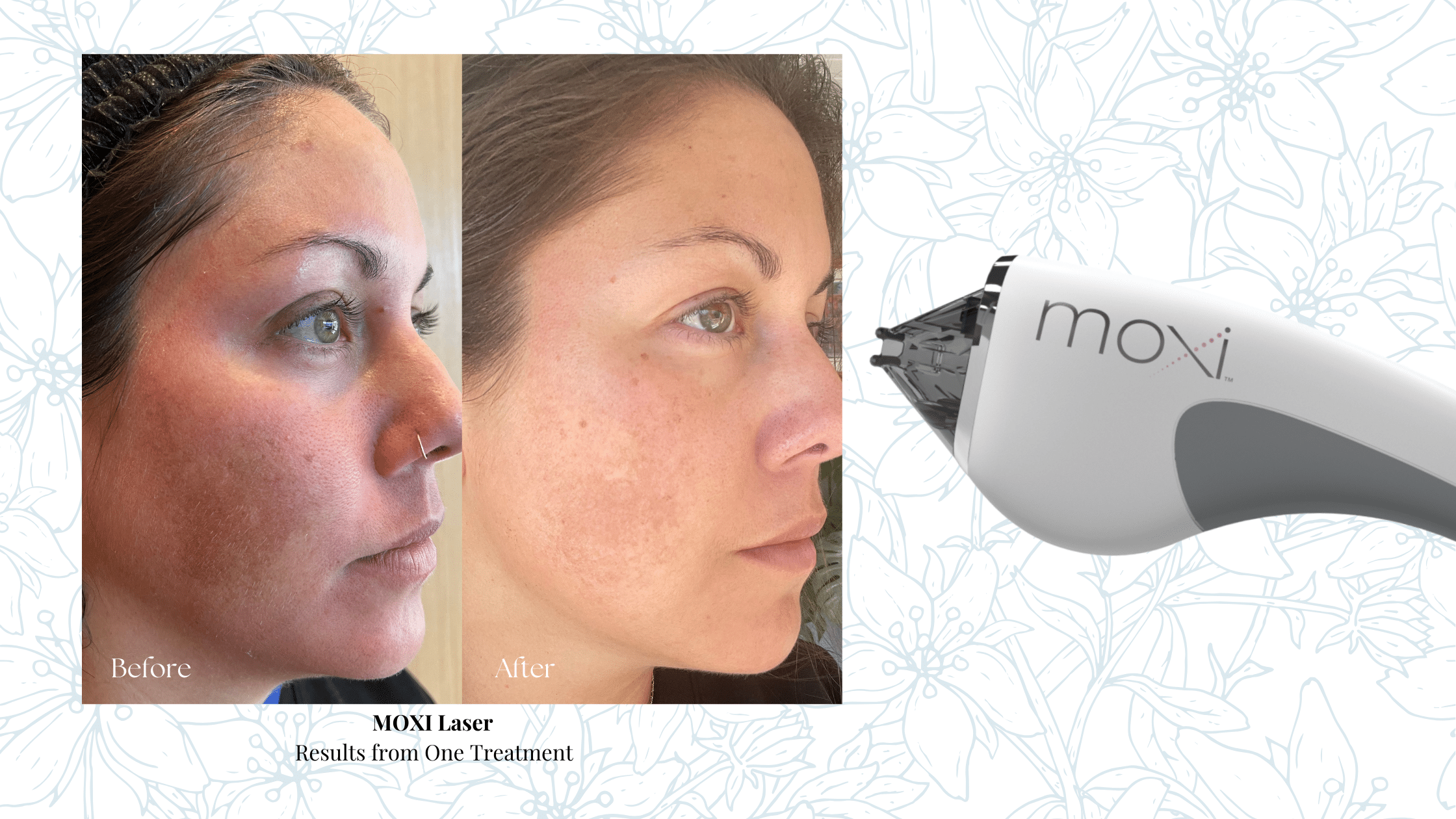 MOXI laser services available in Cincinnati OH & Covington KY