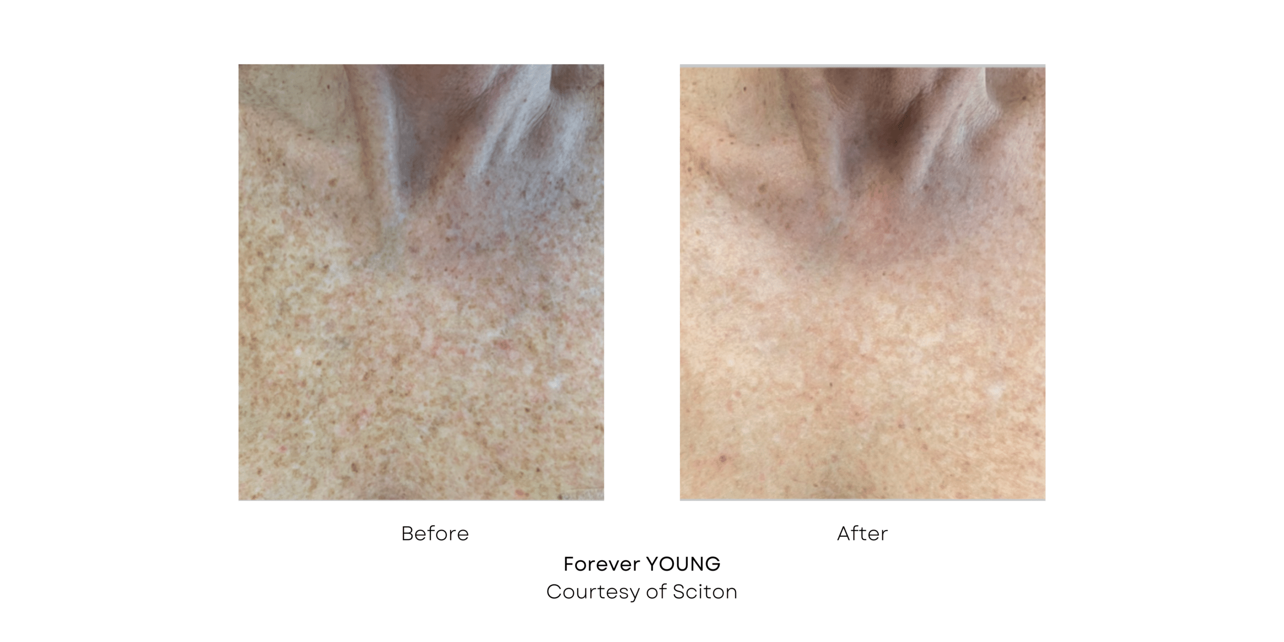 Nonsurgical BBL treatments in Cincinnati OH & Covington KY