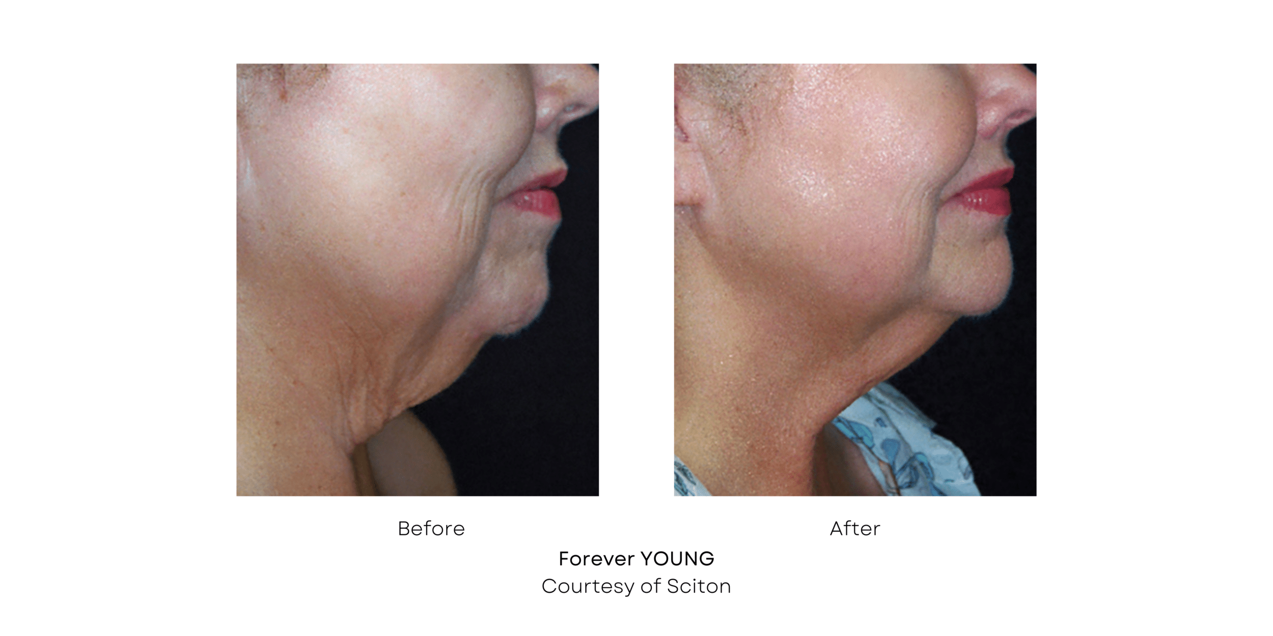 Nonsurgical BBL treatments in Cincinnati OH & Covington KY