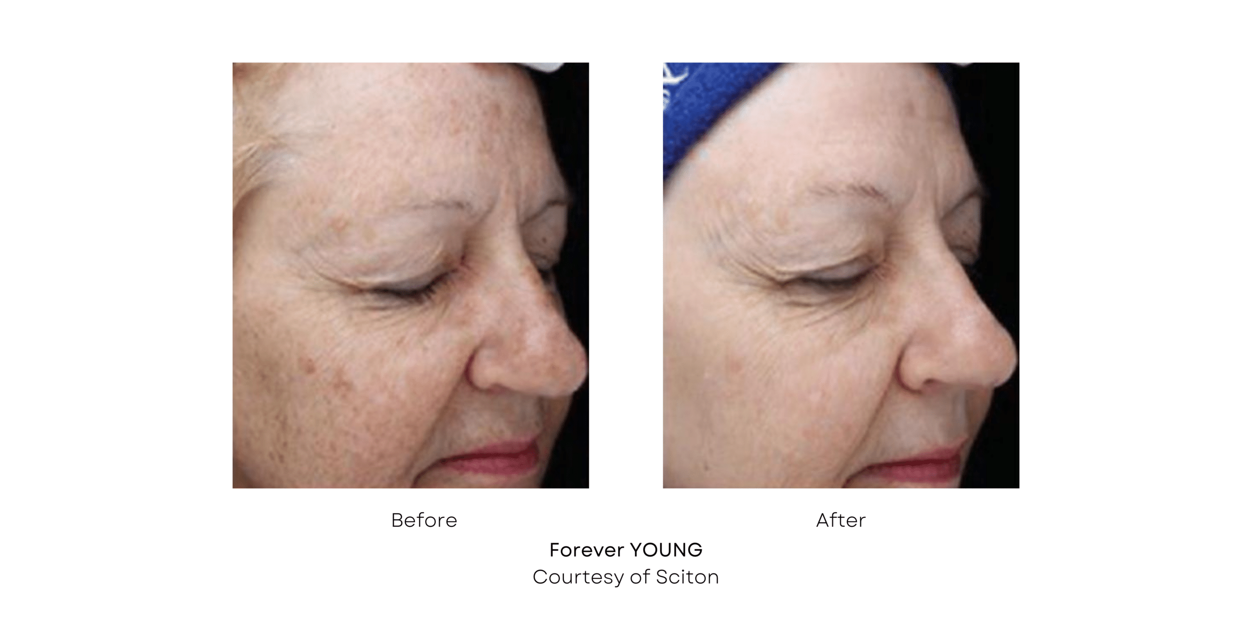 Nonsurgical BBL treatments in Cincinnati OH & Covington KY