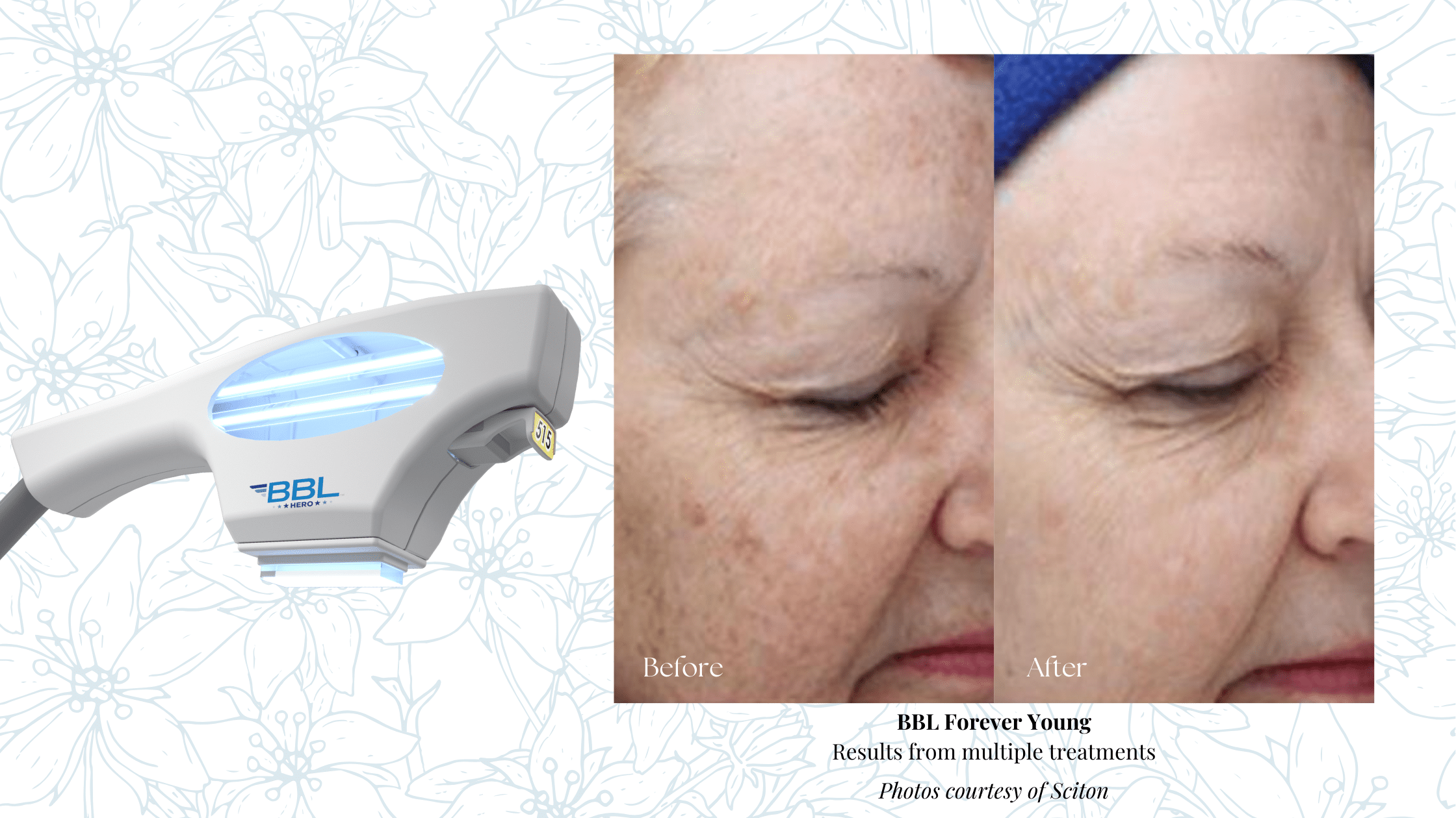 Med spa rejuvenation devices in Cincinnati OH & Covington KY